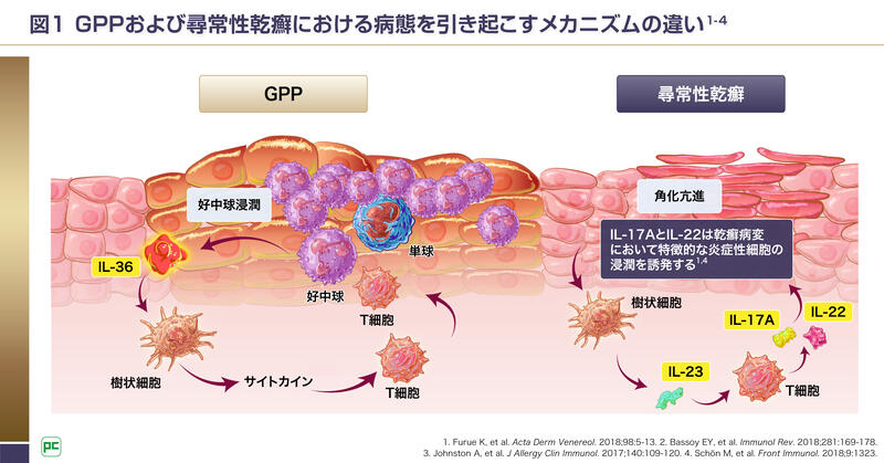 膿疱性乾癬（GPP）の病態におけるIL-36の役割｜べーリンガープラス