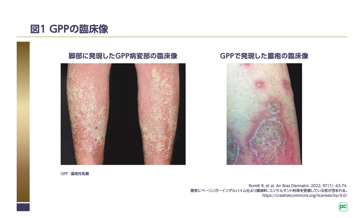 GPPとAGEPの適切な鑑別のためにー鑑別のためのスコアリングシステムー | べーリンガープラス