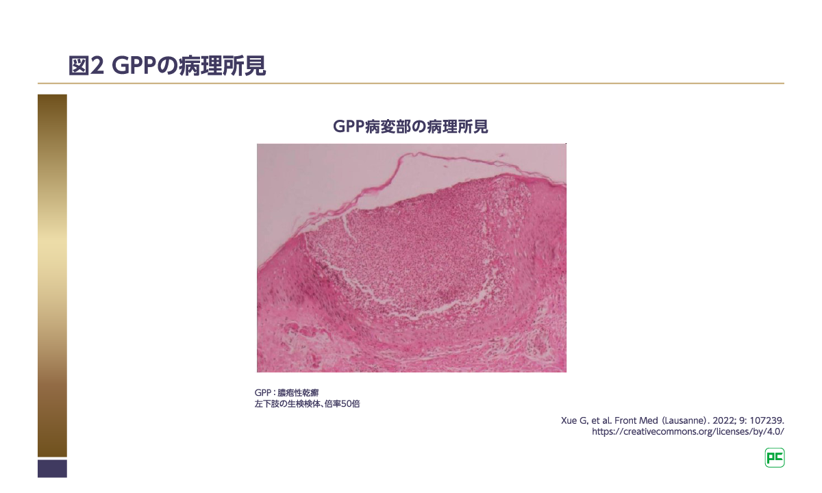 GPPとAGEPの適切な鑑別のためにー鑑別のためのスコアリングシステムー | べーリンガープラス