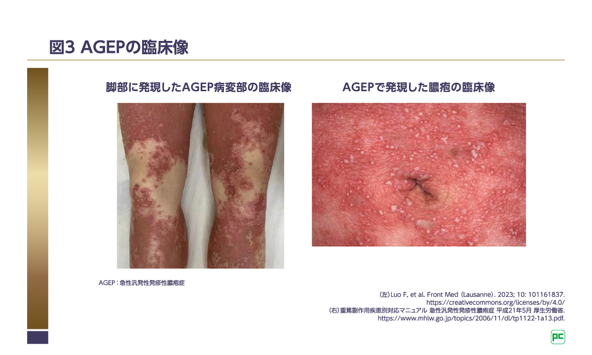 GPPとAGEPの適切な鑑別のためにー鑑別のためのスコアリングシステムー | べーリンガープラス