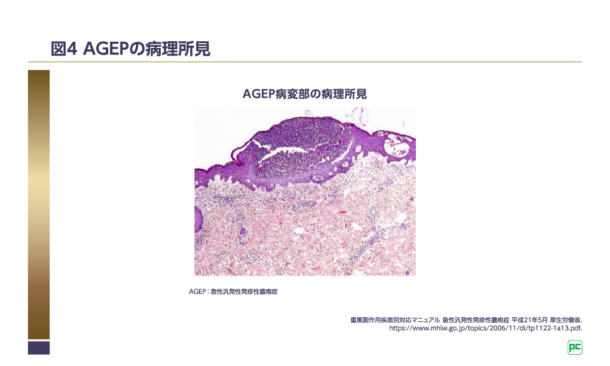 GPPとAGEPの適切な鑑別のためにー鑑別のためのスコアリングシステムー | べーリンガープラス