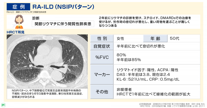 関節リウマチに伴う間質性肺疾患患者さんの診断と治療（NSIPパターン）静止画｜べーリンガープラス