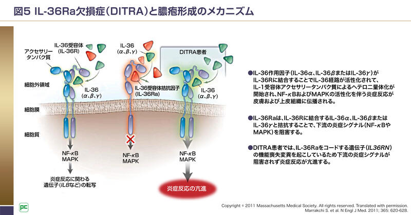 膿疱性乾癬（GPP）の病態におけるIL-36の役割｜べーリンガープラス