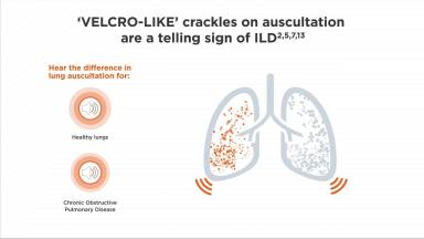 Risk score for RA-ILD Patient | Boehringer Ingelheim
