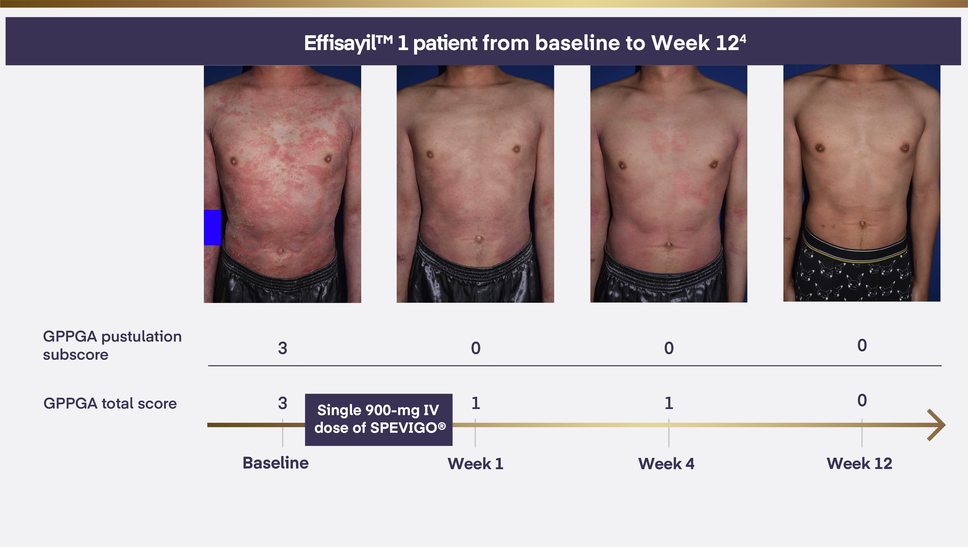 SPEVIGO® Efficacy | SPEVIGO® Clinical Trial Data