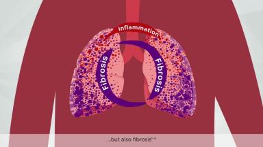 Chronic Fibrosing ILD with a Progressive Phenotype