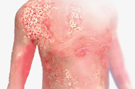 THE IMPACT OF Generalized Pustular Psoriasis | GPP Walks In