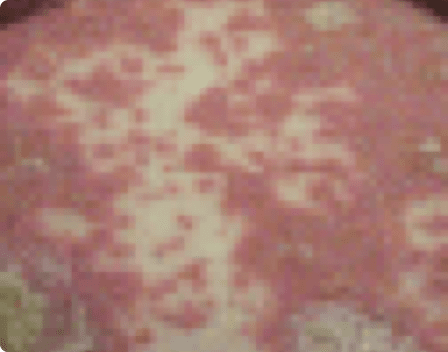 Understanding Generalized Pustular Psoriasis | GPP Walks In