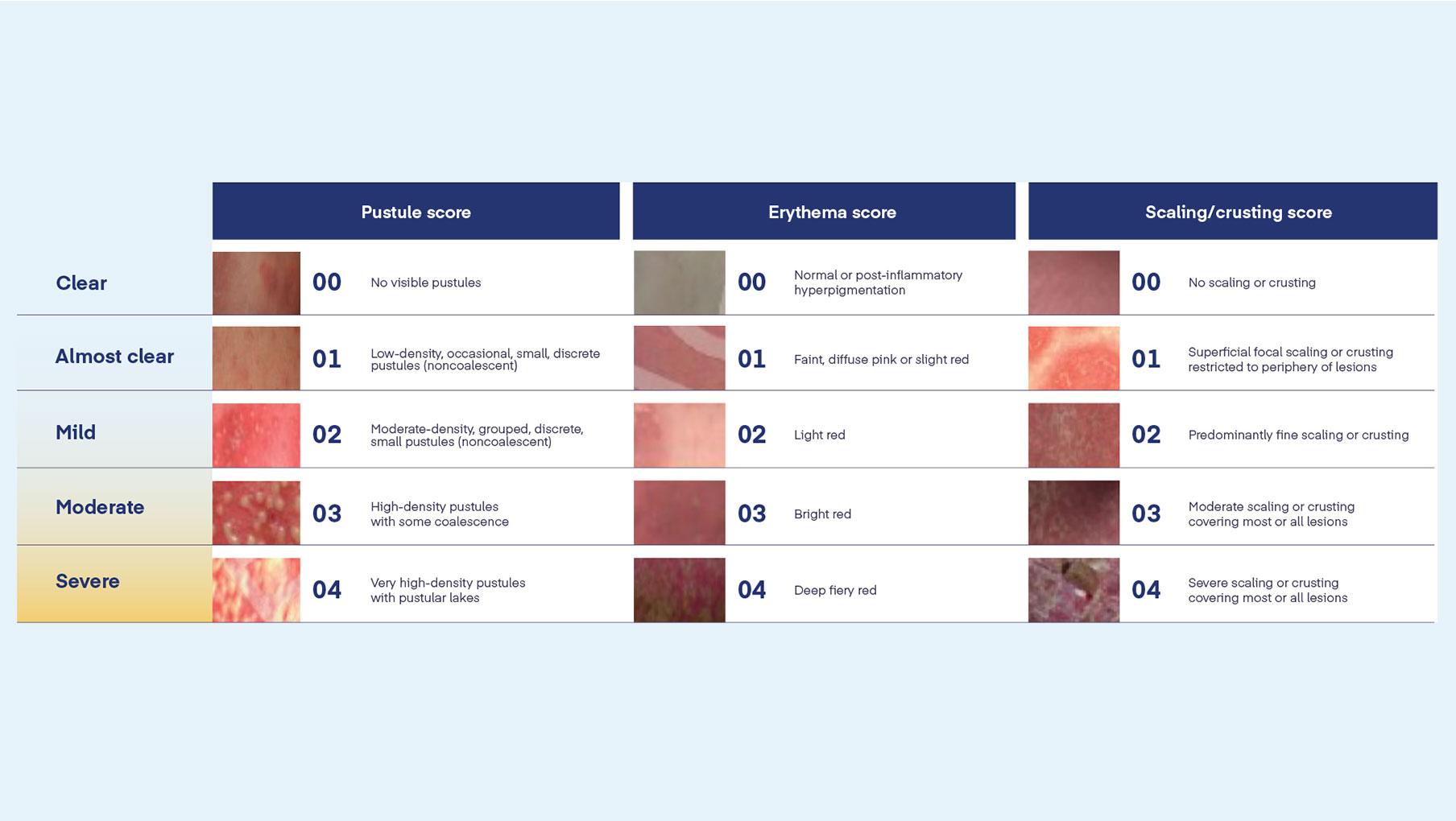 Recognising Generalized Pustular Psoriasis Flares | GPP Walks In