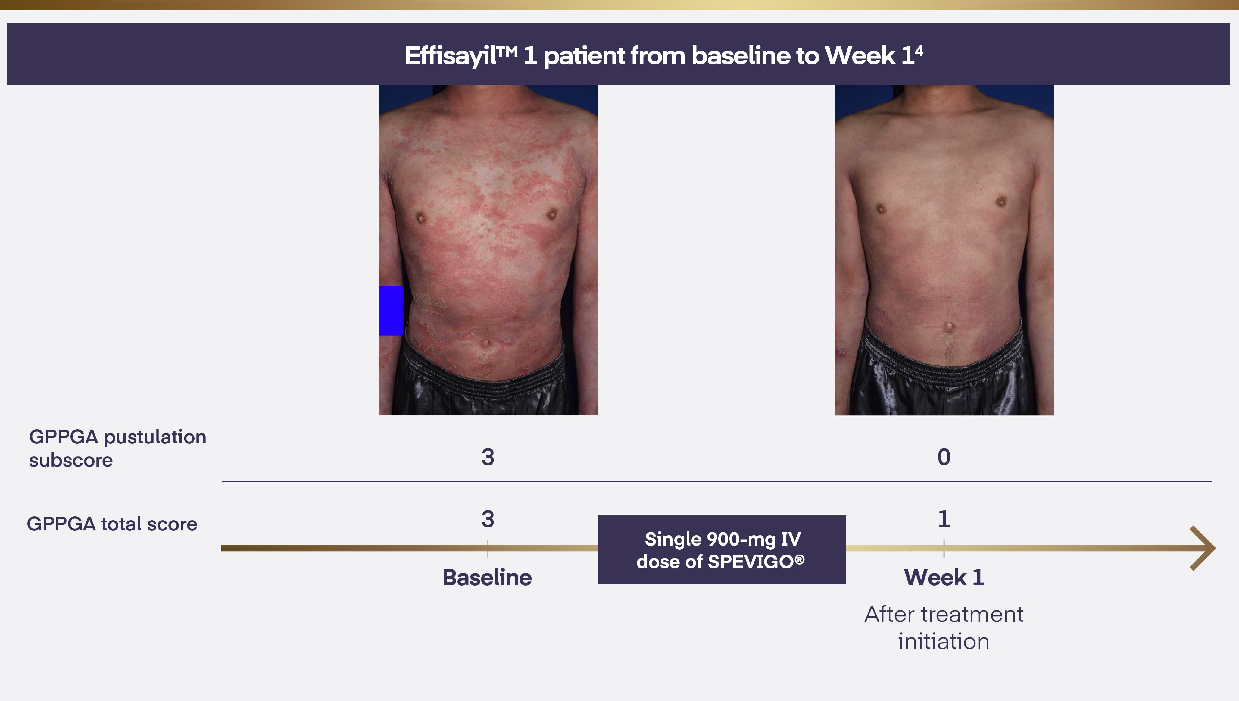 SPEVIGO® Efficacy | SPEVIGO® Clinical Trial Data | SPEVIGO®