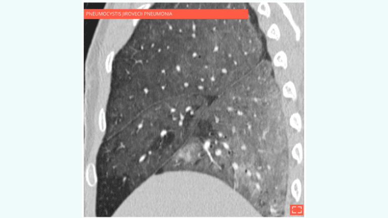 Ground-glass opacity | Boehringer Ingelheim Norway
