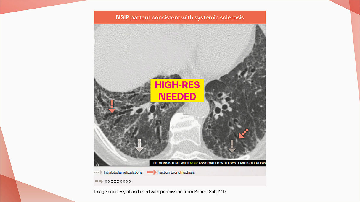 Systemic Sclerosis-Associated ILD | Rheumatologists | PF360