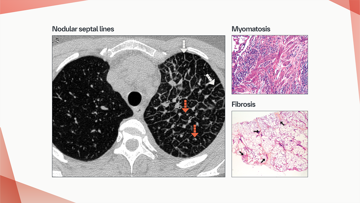 Role of HRCT in diagnosis | Rheumatologists | PF360