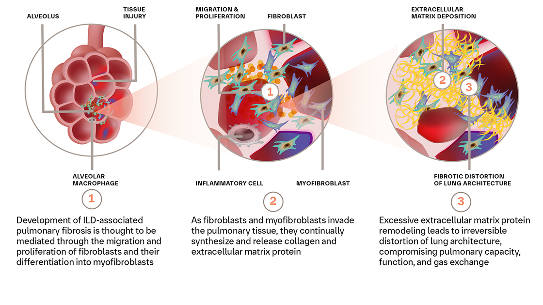 Pathophysiology of fibrotic ILDs | Pulmonologists | PF360