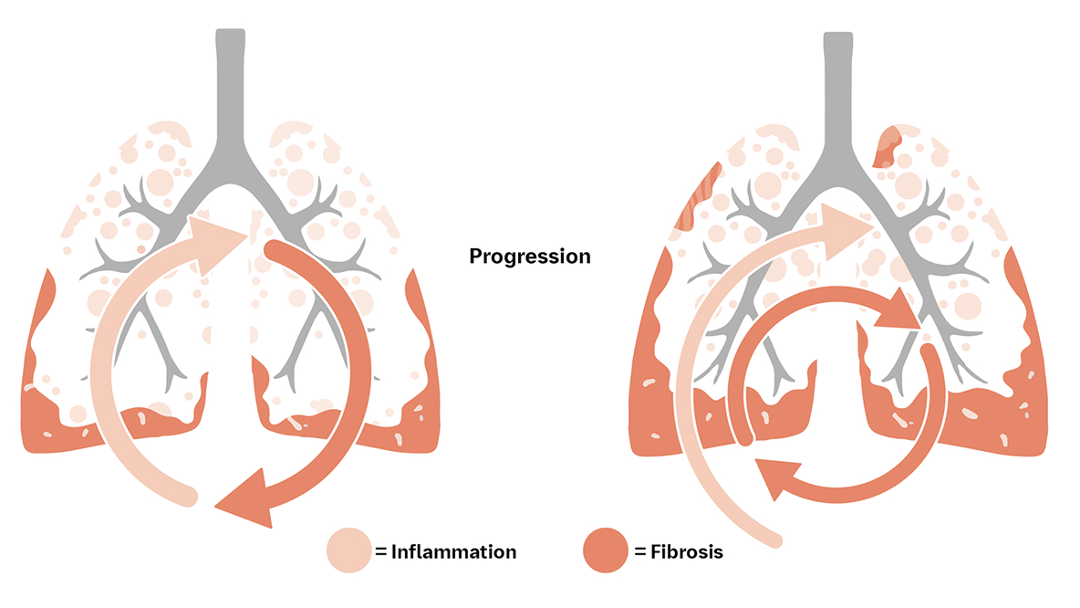Pathophysiology of fibrotic ILDs | Pulmonologists | PF360