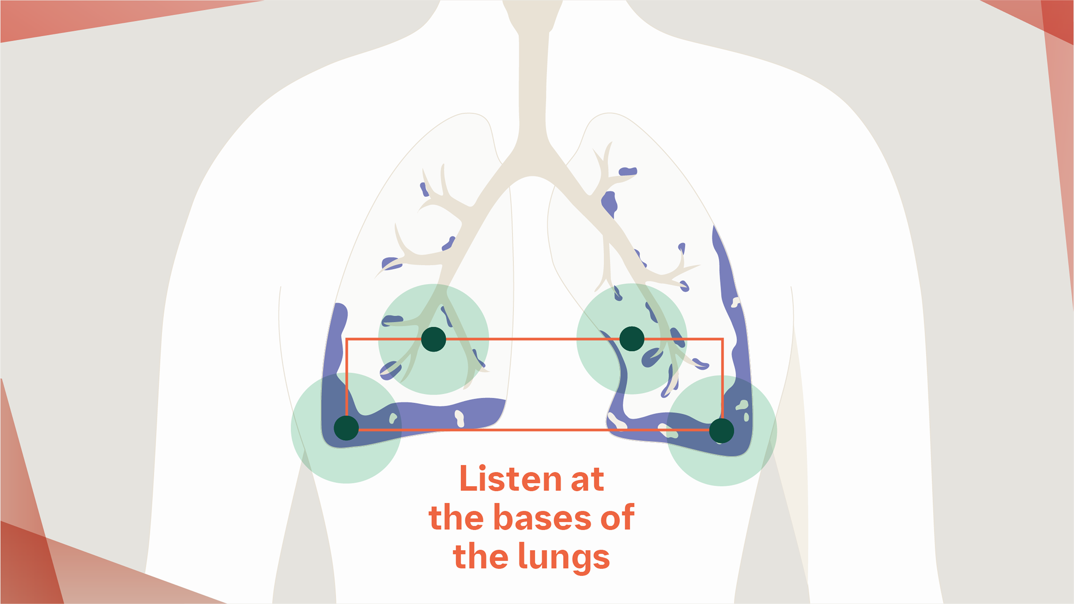 CTD-ILDs screening strategies | Rheumatologists | PF360