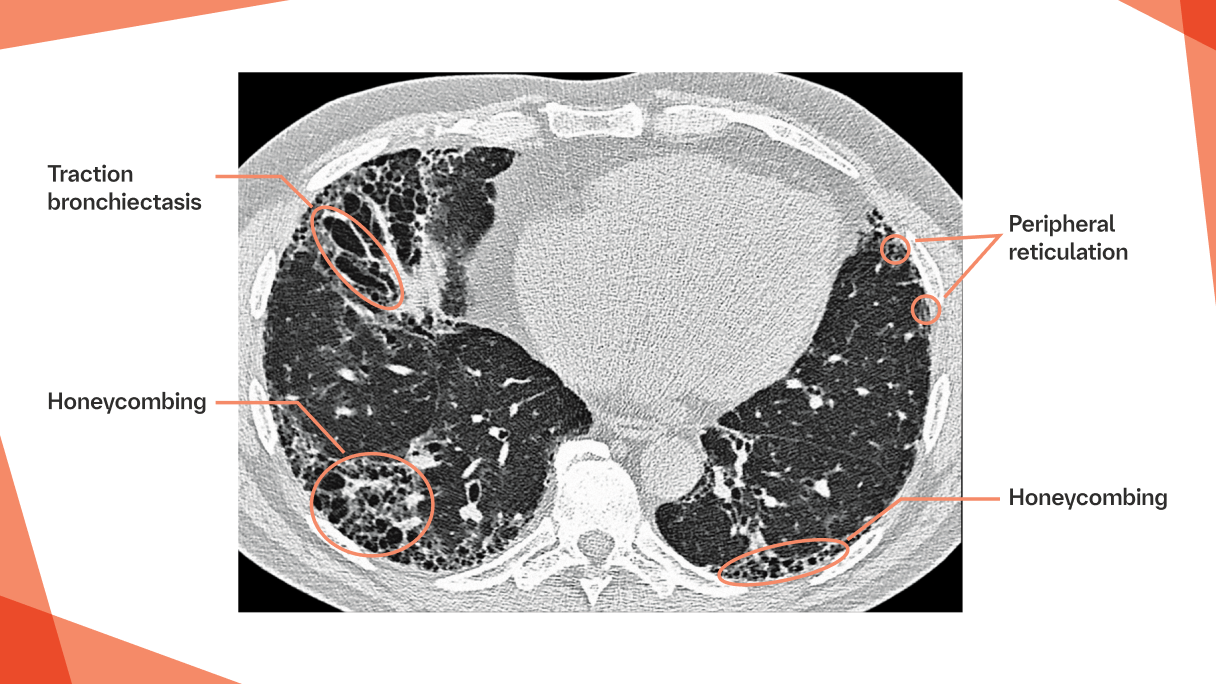 Rheumatoid Arthritis-Associated ILD | Rheumatologists | PF360