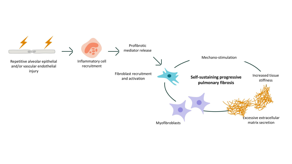 Pathophysiology of fibrotic ILDs | Pulmonologists | PF360
