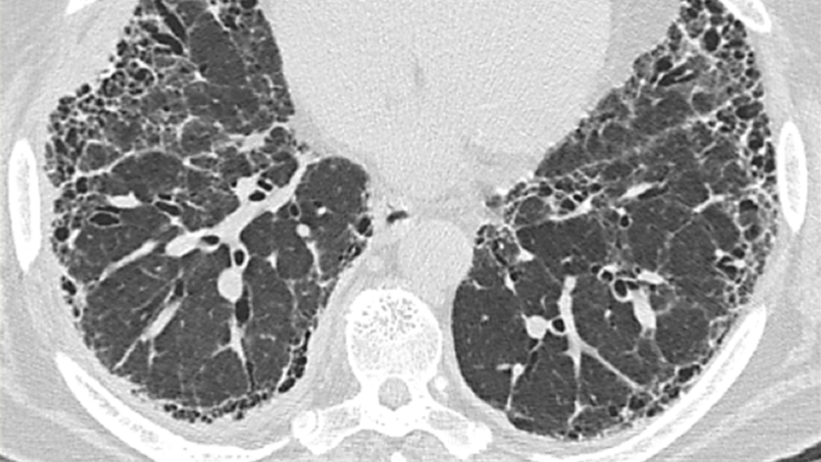 Diagnosis of Pulmonary Fibrosis | Pulmonologists | PF360