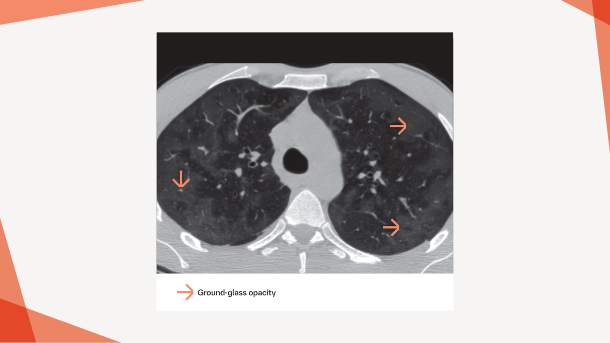 Importance of HRCT for ILD identification and monitoring | PF360
