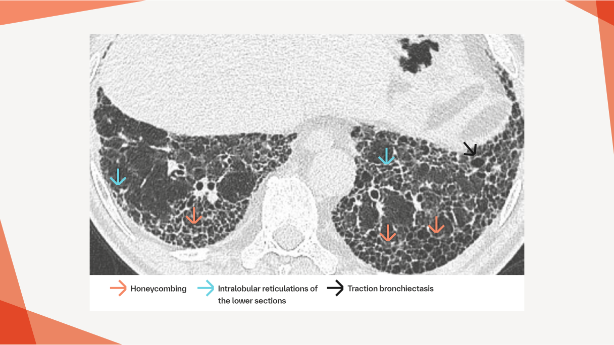 Importance of HRCT for ILD identification and monitoring | PF360