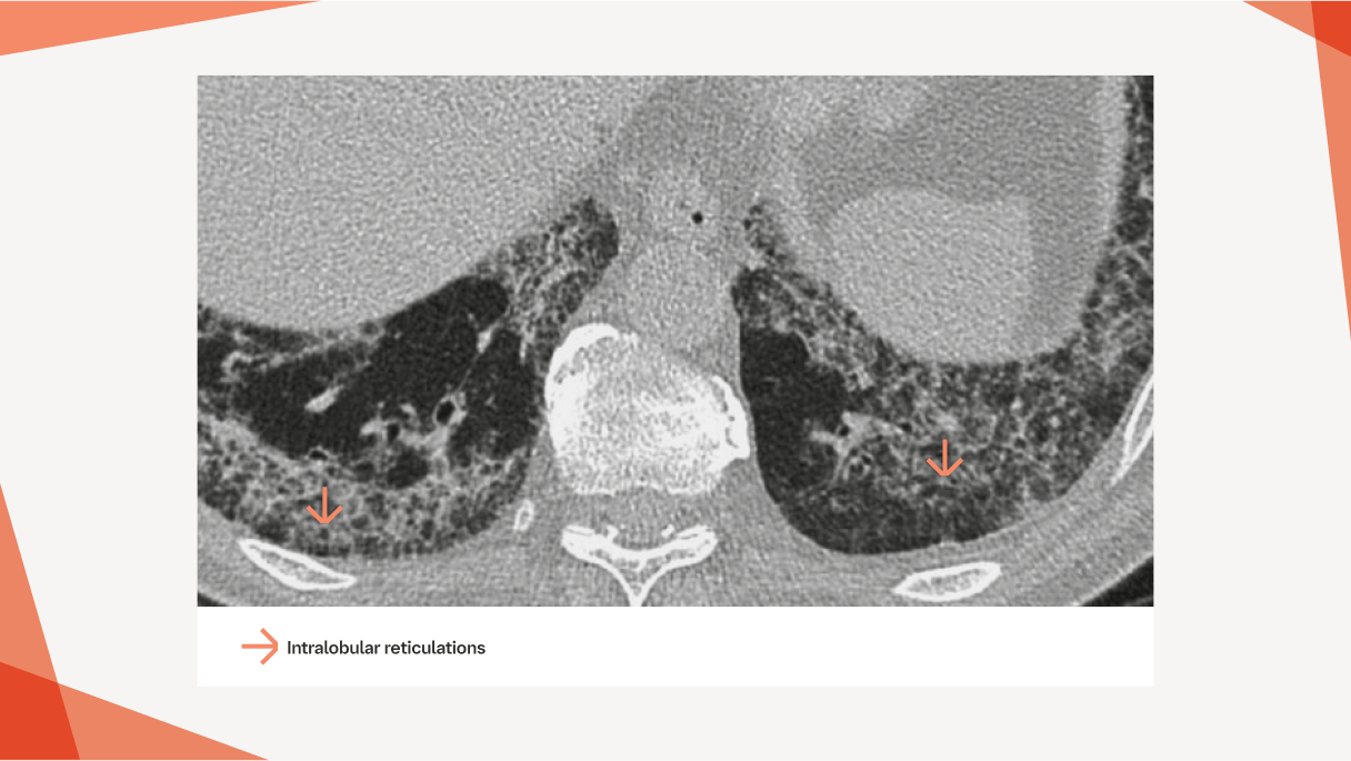 Importance of HRCT for ILD identification and monitoring | PF360