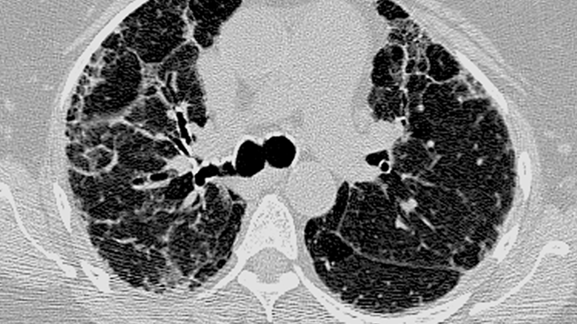 Diagnosis of Pulmonary Fibrosis | Pulmonologists | PF360