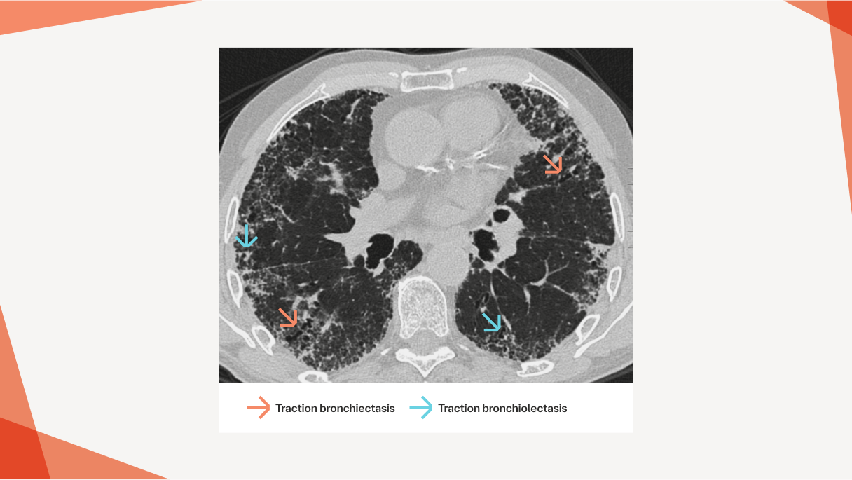 Importance of HRCT for ILD identification and monitoring | PF360