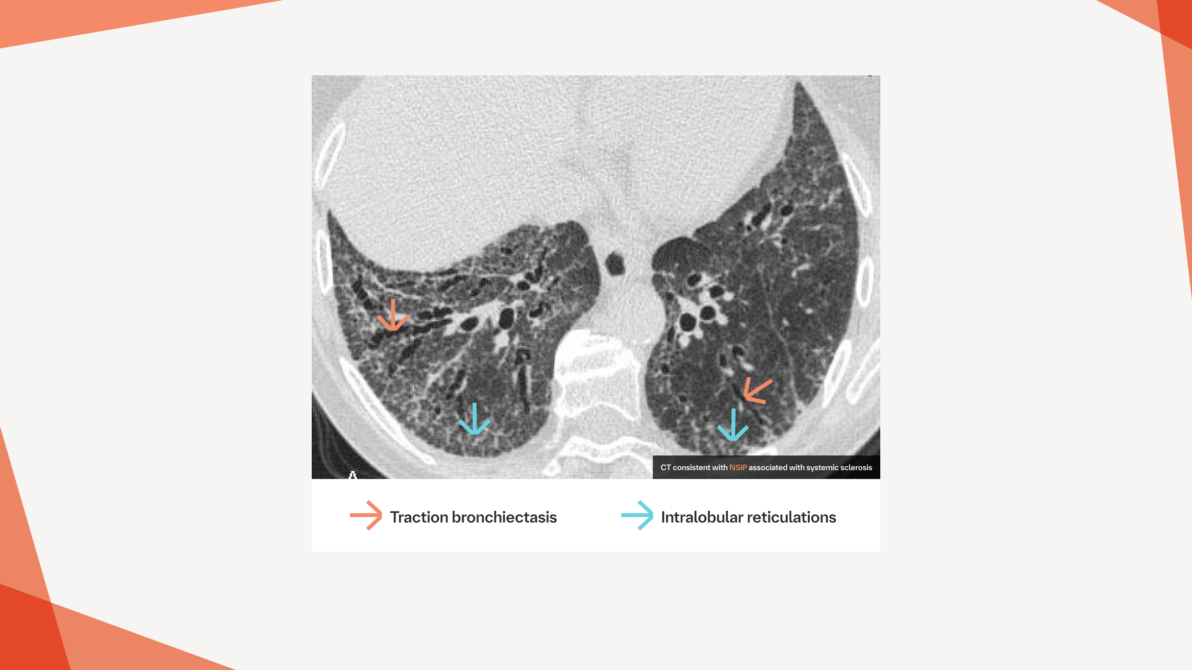 Systemic Sclerosis-Associated ILD | Rheumatologists | PF360