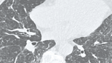 Interstetiell lungsjukdom | Boehringer Ingelheim Sweden