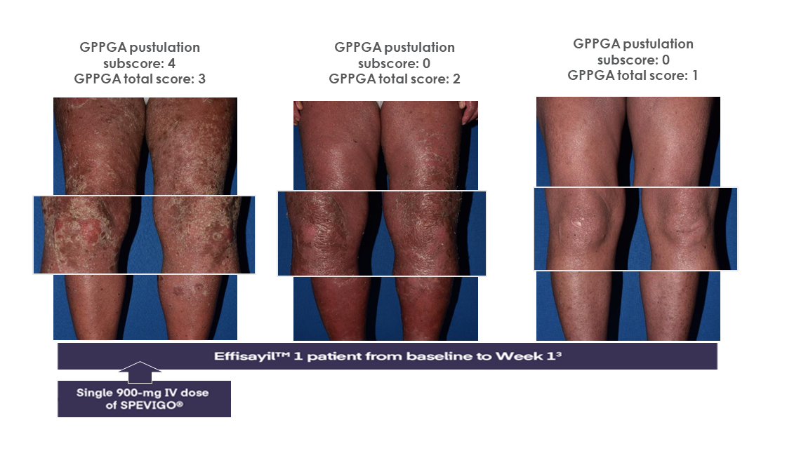 Spevigo® Efficacy Spevigo® Clinical Trial Data Spevigo® Spesolimab