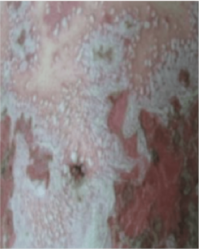 Recognising Generalized Pustular Psoriasis Flares | GPP Walks In