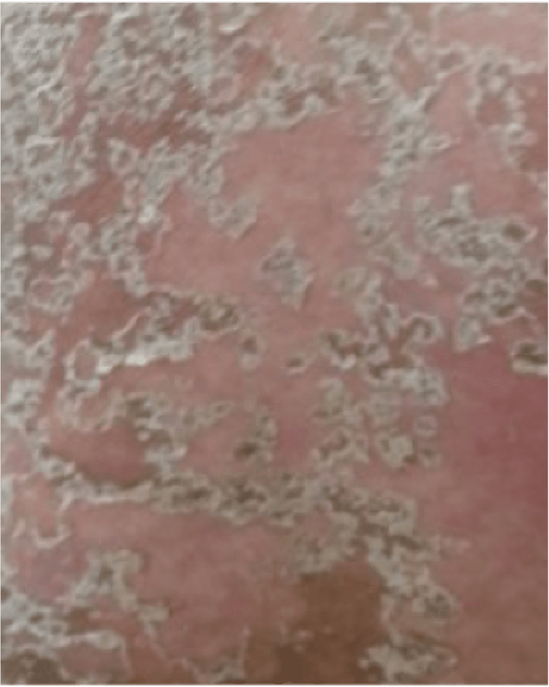 Recognising Generalized Pustular Psoriasis Flares | GPP Walks In