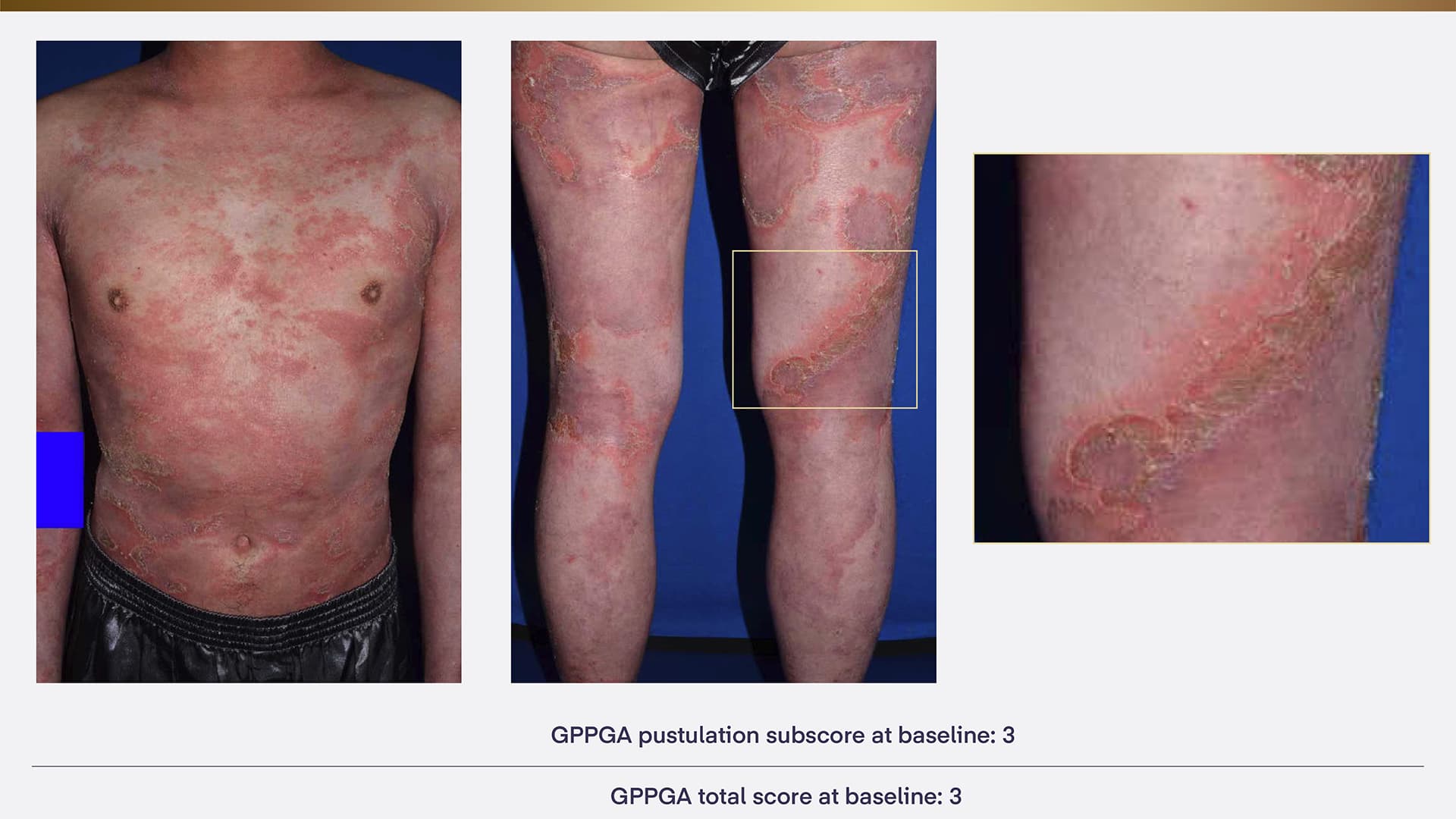 About GPP | GPP flares | GPP Images | SPEVIGO® (Spesolimab)