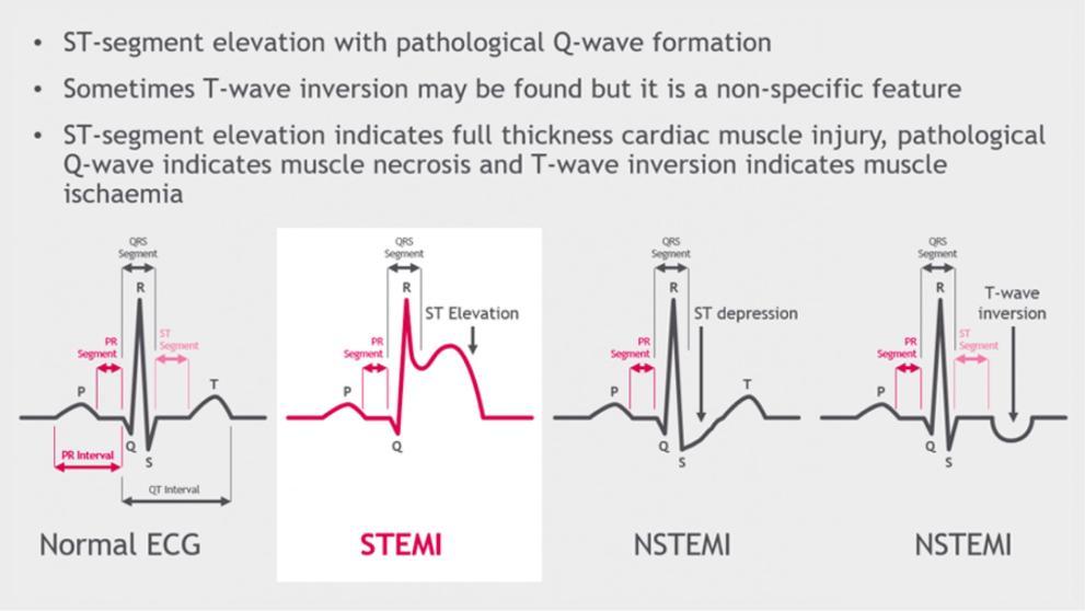 Diagnosis of STEMI Diagnosis of STEMI