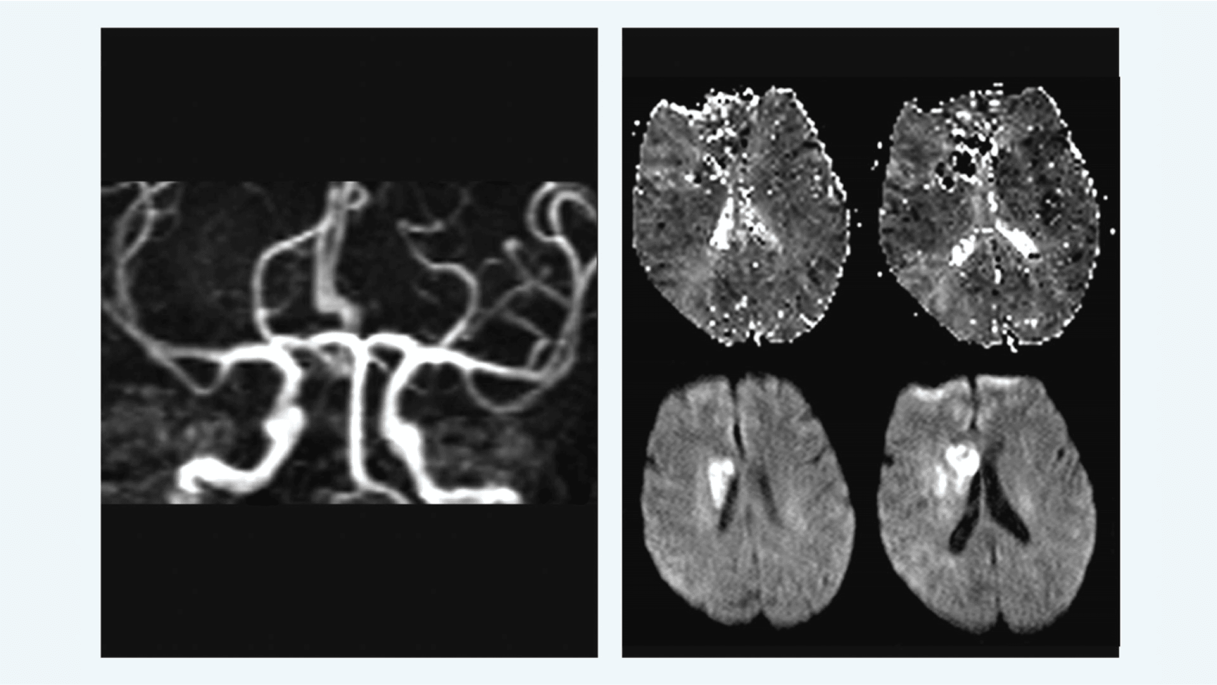 Studies & registries | Strokeforum