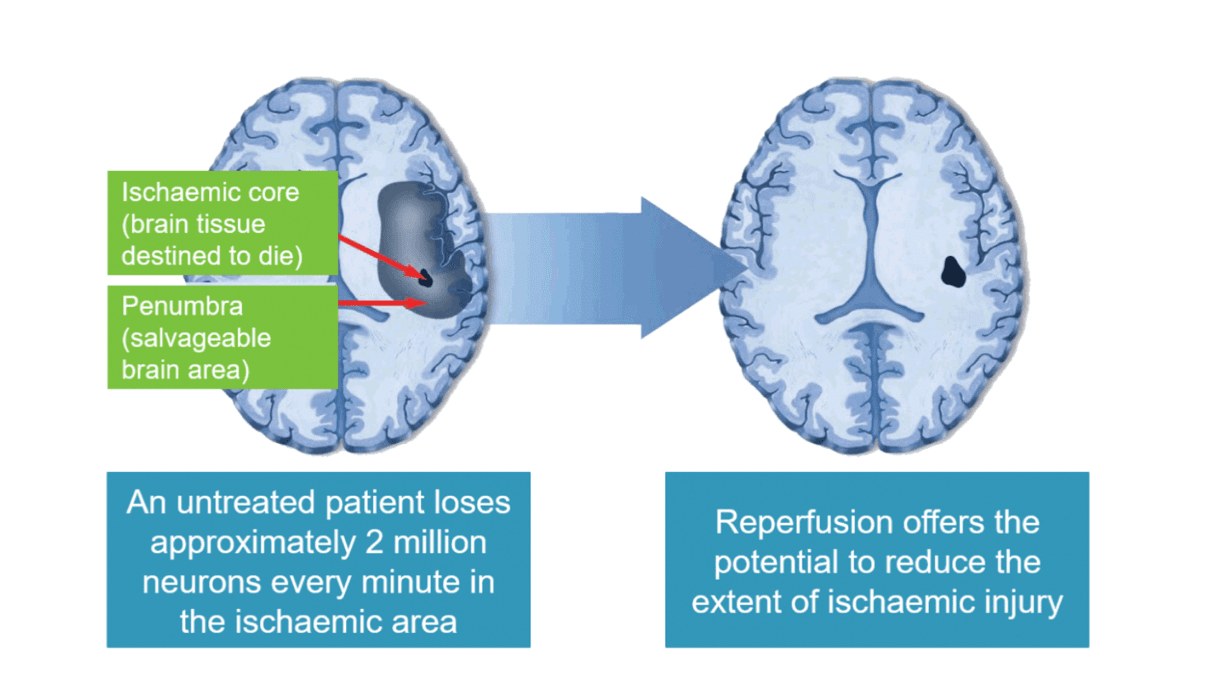 Acute Stroke Management | Strokeforum