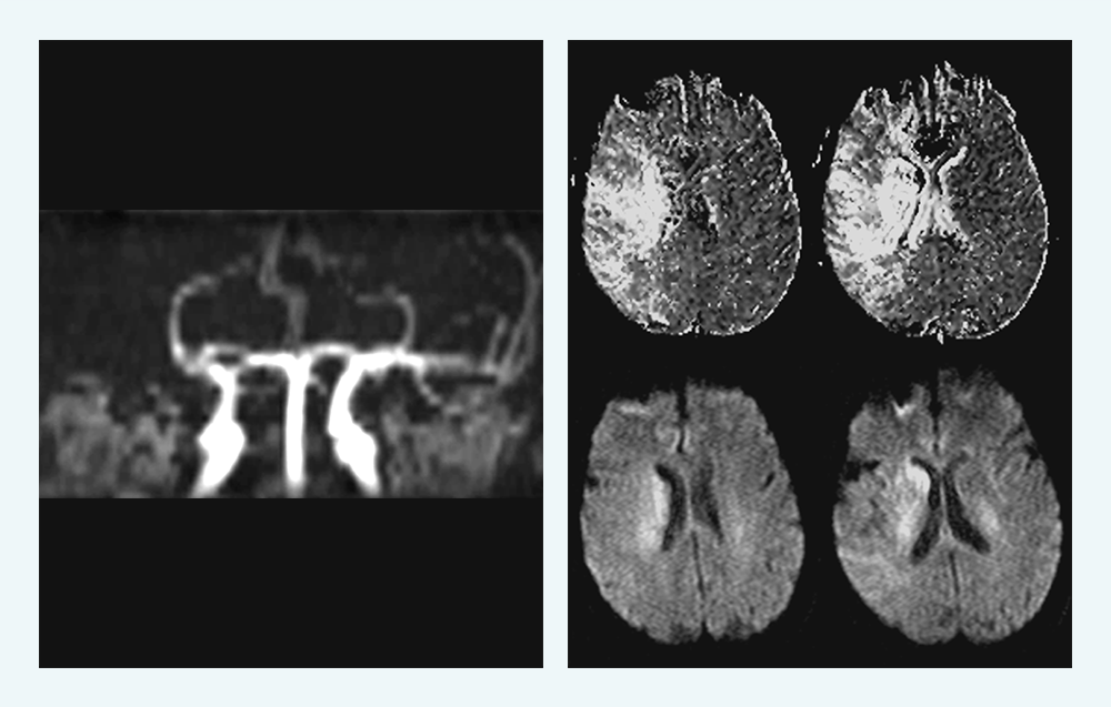 Studies & registries | Strokeforum