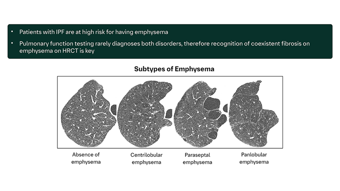 Comorbid Conditions on HRCT | ILD Radiology Rounds