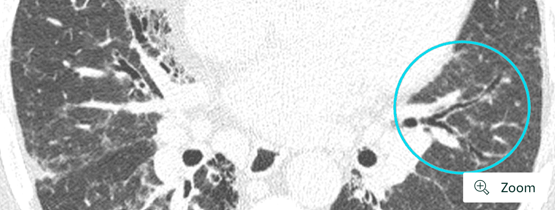 Recognizing Features of ILD on HRCT | ILD Radiology Rounds