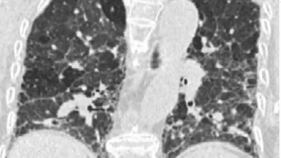 Fibrotic HP Case Study | ILD Radiology Rounds