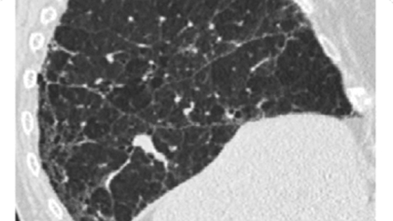 Fibrotic HP Case Study | ILD Radiology Rounds