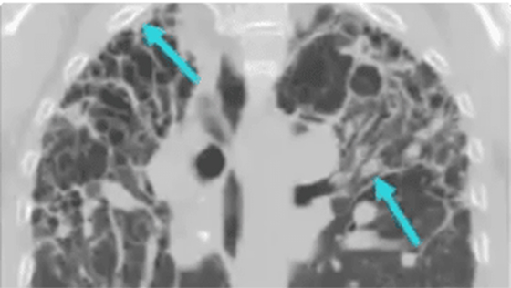 Diagnosing Interstitial Lung Disease | ILD Radiology Rounds