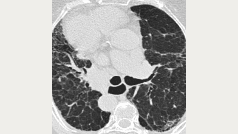 Differentiating Fibrotic HP, NSIP & UIP On HRCT | ILD Radiology Rounds