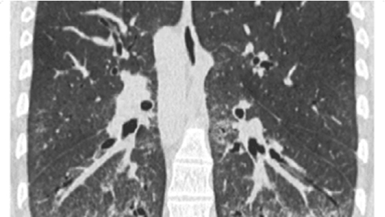 Scleroderma-associated ILD Case Study | ILD Radiology Rounds