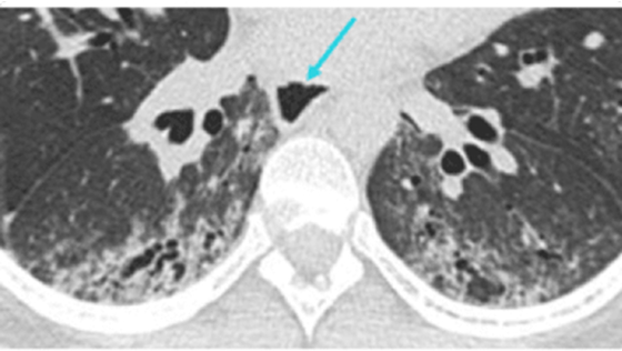 Scleroderma-associated ILD Case Study | ILD Radiology Rounds
