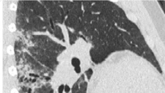 Scleroderma-associated ILD Case Study | ILD Radiology Rounds
