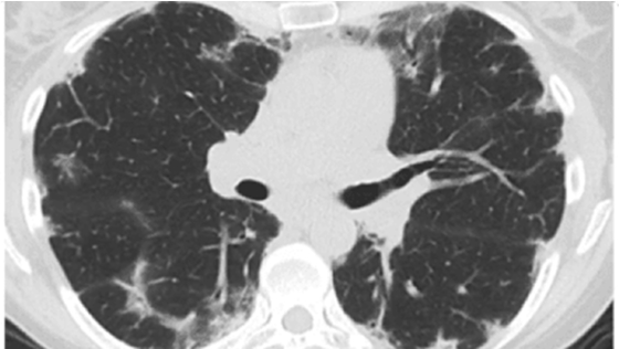 Rheumatoid Arthritis ILD Study | ILD Radiology Rounds