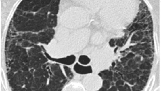 Fibrotic HP Case Study | ILD Radiology Rounds