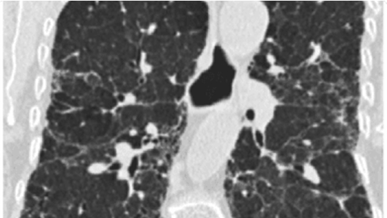 Fibrotic HP Case Study | ILD Radiology Rounds